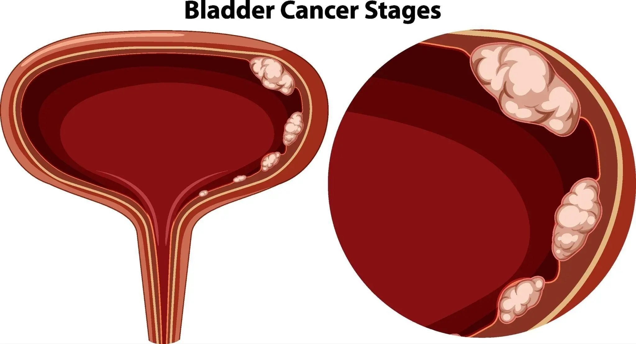 Hematuria | Blood in Urine: Warning Sign of Bladder Cancer? - Dr Zubair ...